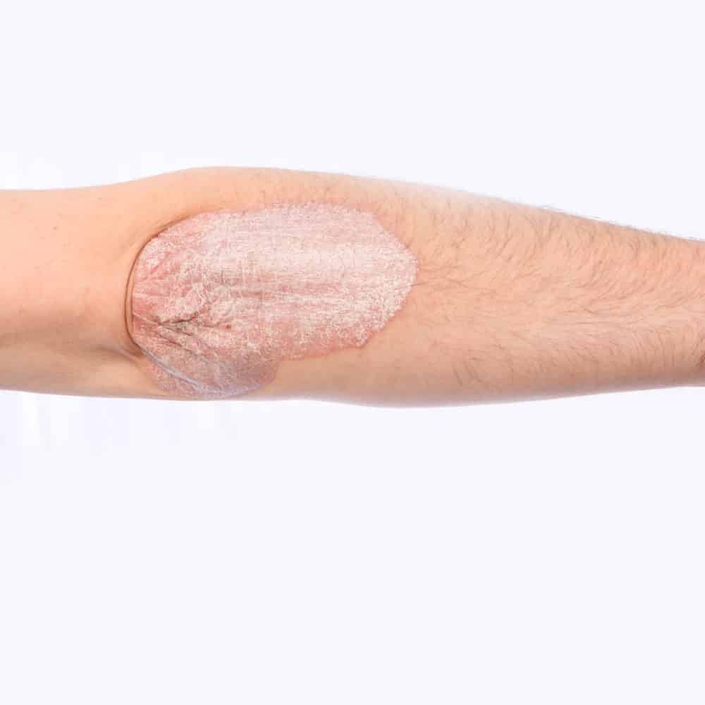 Are Skin Tags Cancerous? | Short Hills Dermatology