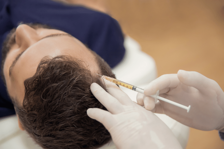How PRP Injections Treat Hair Loss