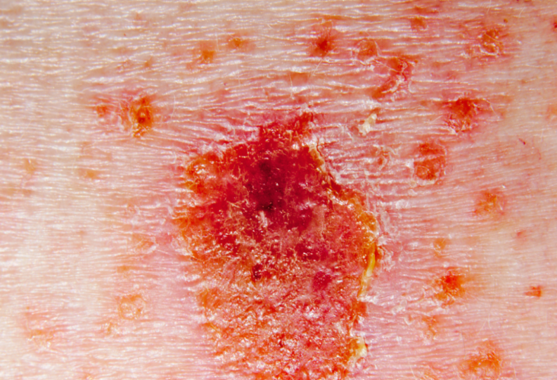 What Are the Different Forms of Eczema? | Short Hills Dermatology