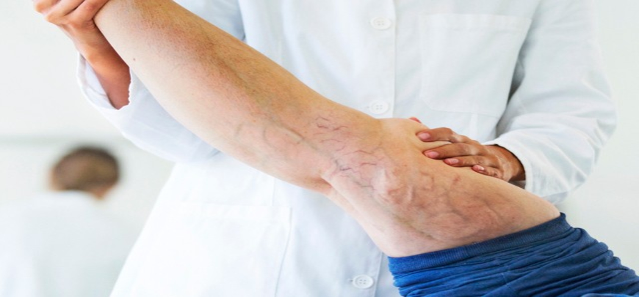 Spider Veins Treatment & Scleropathy | Short Hills Dermatology NJ