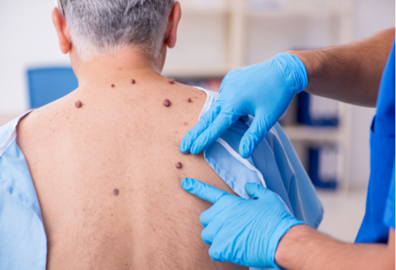 Is my mole a sign of skin cancer? - Short Hills Dermatology