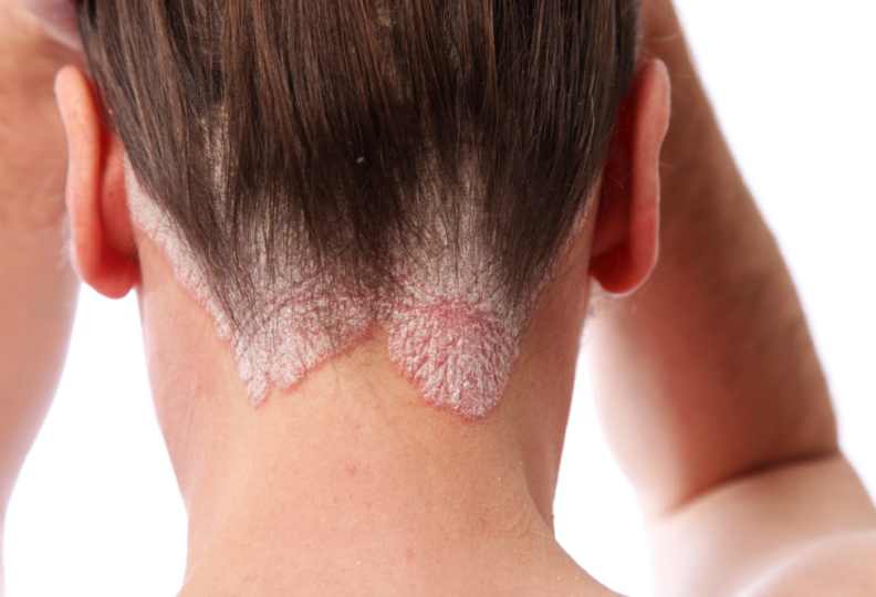 Symptoms of Scalp Psoriasis | Short Hills Dermatology