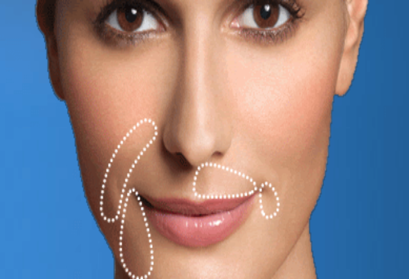 What is the Pain Level for Restylane? | Short Hills Dermatology